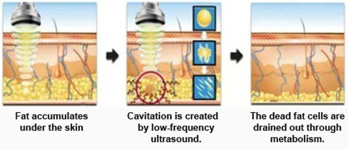 Cavitation Treatment Science - Rf and Cavitation